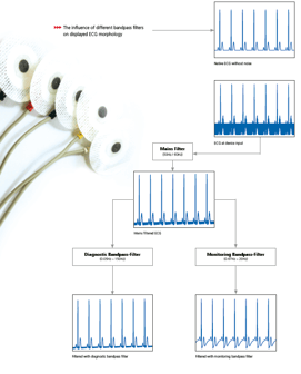 ECG Filtering that can help save lives!